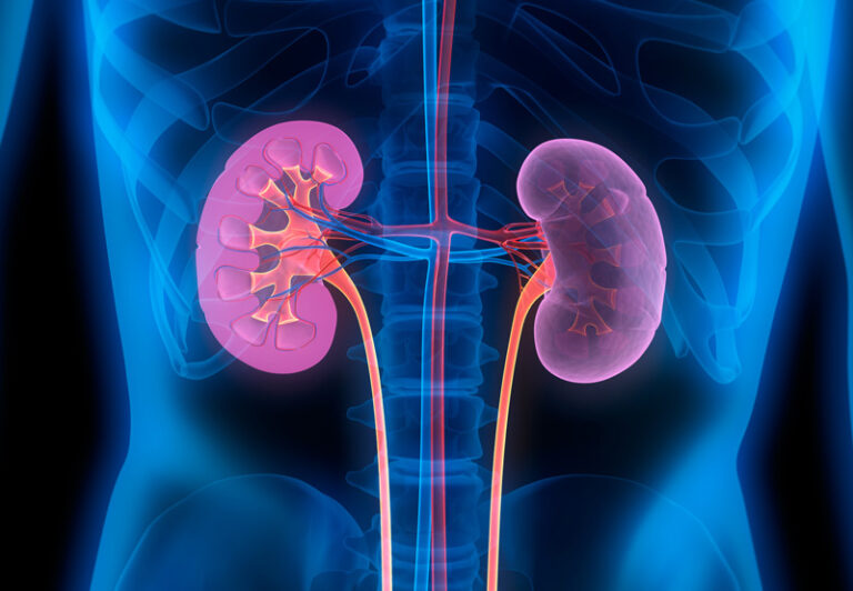 Percutaneous Nephrolithotomy (PCNL) - Endourology, Kidney Stones ...